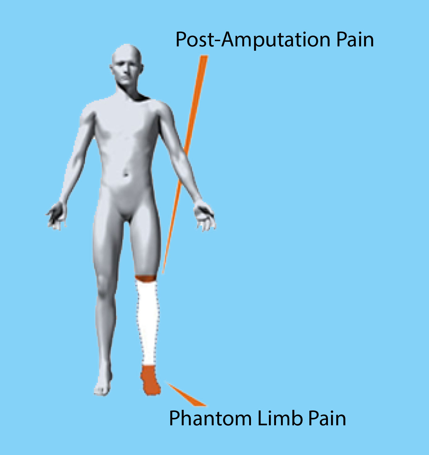 Phantom Limb Pain - Condition And Treatment Information